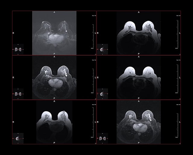 Mammograms May Also Reveal Hidden Heart Disease Risk, Study Finds