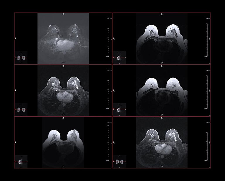 Mammograms May Also Reveal Hidden Heart Disease Risk, Study Finds