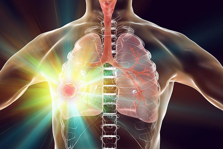 Selpercatinib Ups Event-Free Survival in RET-Fusion Positive NSCLC