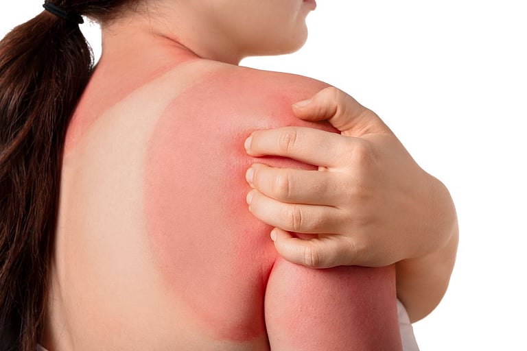 Sunburn Relief: Treatment and Prevention Tips
