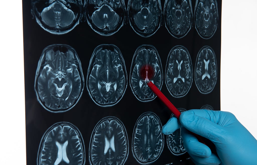 Understanding Stroke: Types, Symptoms, Causes and Treatments
