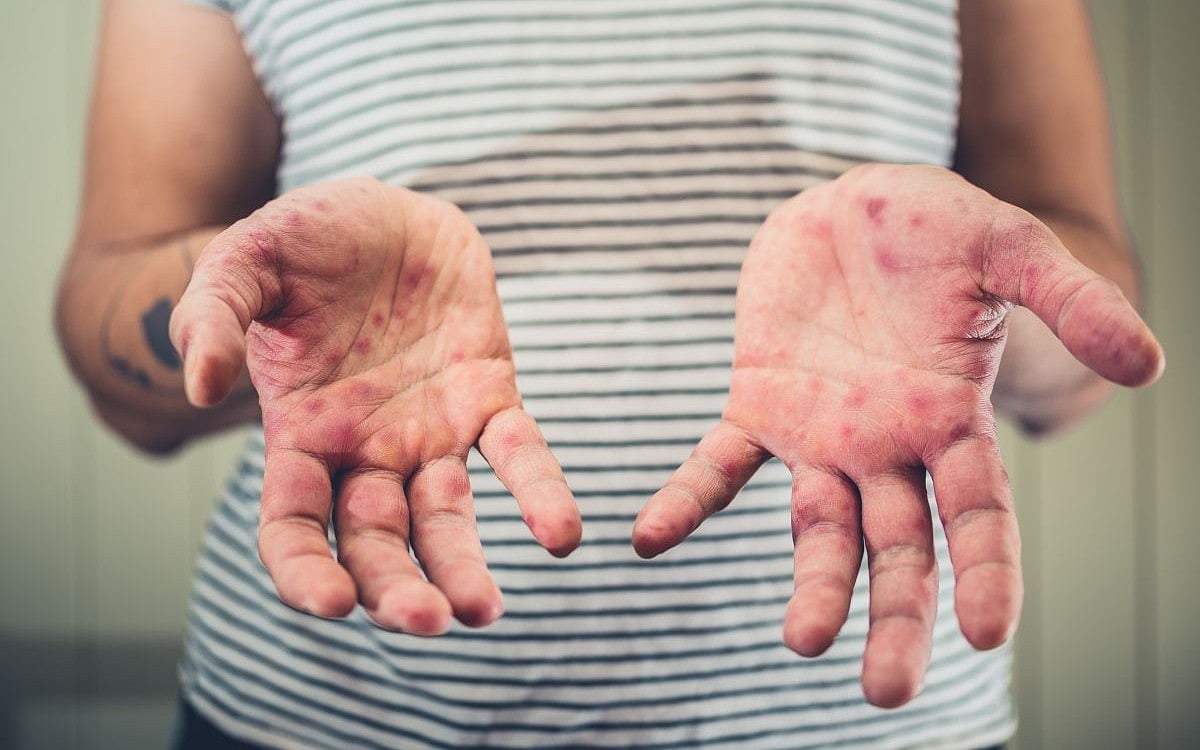 Colorado Reporting New Outbreak of Measles