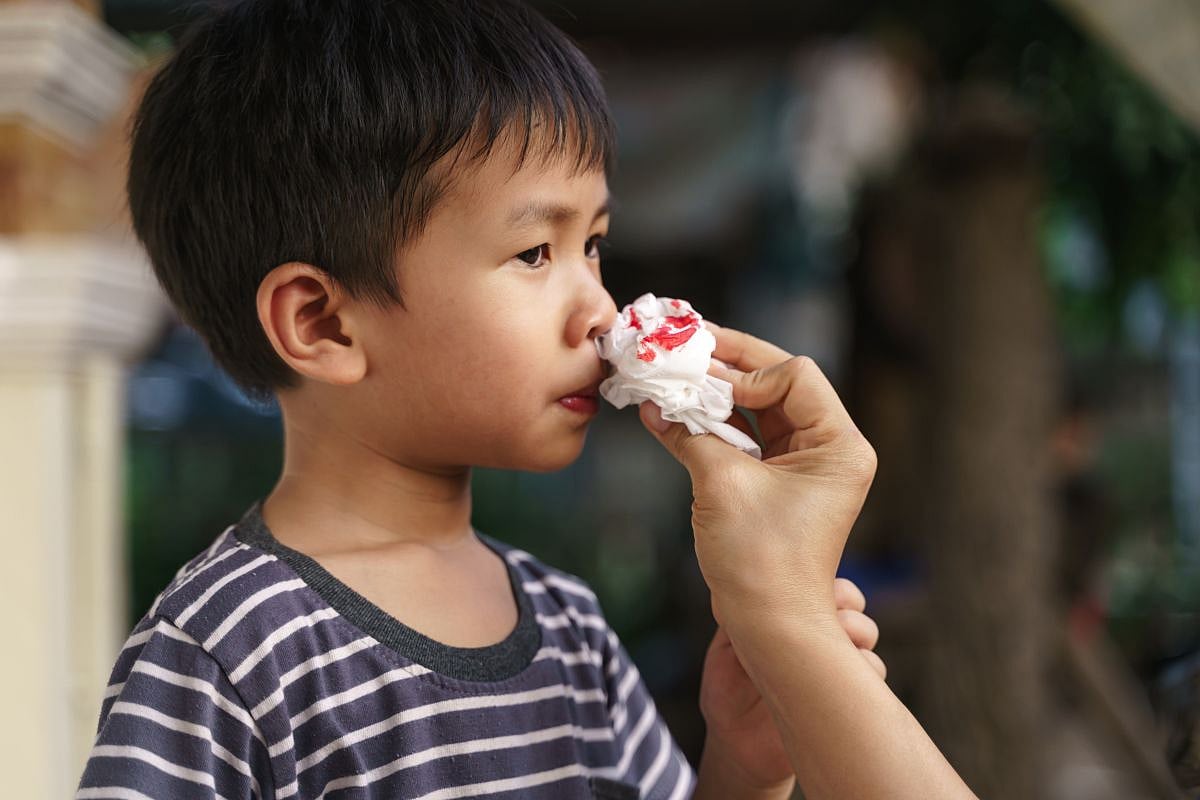 Radiofrequency Coagulation Effective for Recurrent Anterior Epistaxis