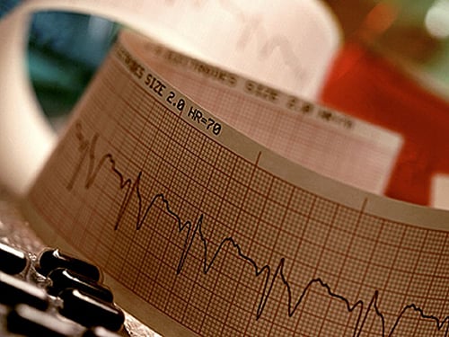 Understanding Heart Pacemakers: How They Work and Save Lives