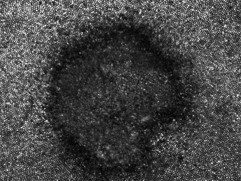 Structural Findings of Acute Solar Retinopathy Described