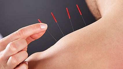 Acupuncture: What It Is, Health Benefits, Safety & Side Effects