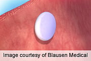 Large Variation in Lipid Reduction With High-Dose Statin Tx