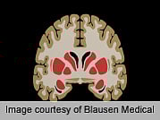Altered Brain Structure Seen in Institutionalized Children