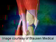 Periarticular Injection Superior to Epidural Analgesia in TKA