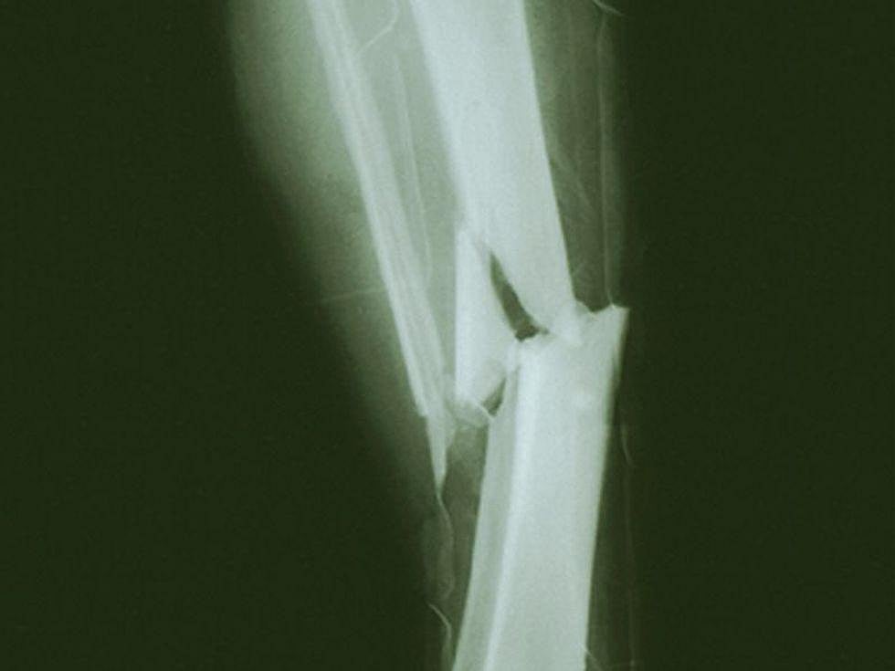 bone fracture risk rises in cancer survivors