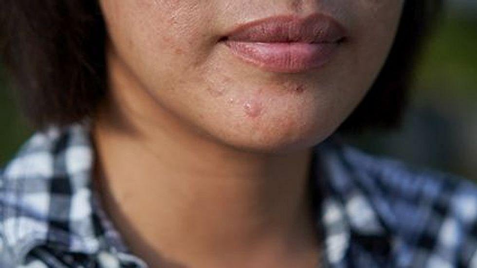 Acne in Adults Can Bring Stigma at Work, Social Lives
