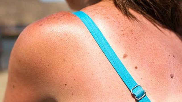 Sunburn Relief: Treatment and Prevention Tips