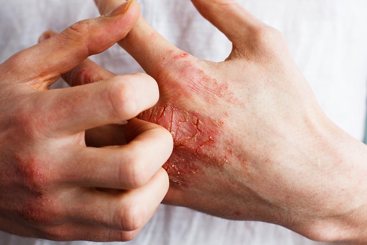 Inflammatory Skin Diseases Classified at Molecular Level