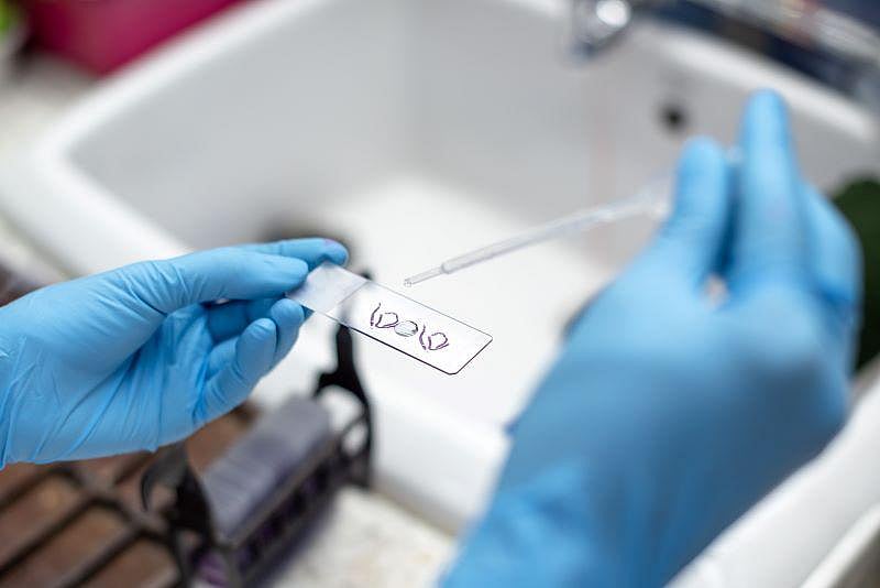 Model Predicts CRC Risk in Ulcerative Colitis Patients With LGD