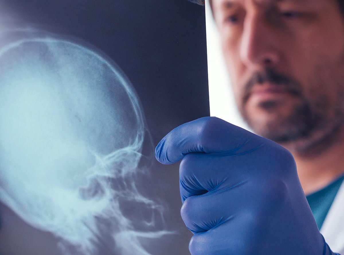 Head Trauma Can Spur 'Spatial Neglect' Similar to a Stroke