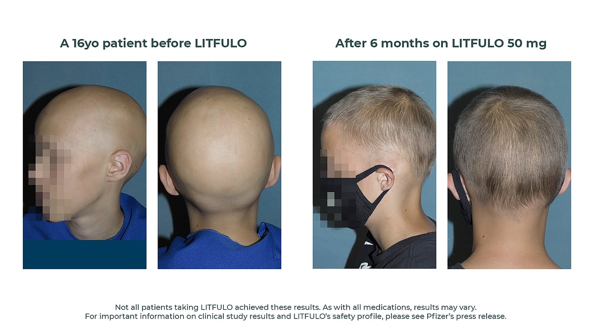 FDA Approves Litfulo for Teens, Adults With A.lopecia Areata