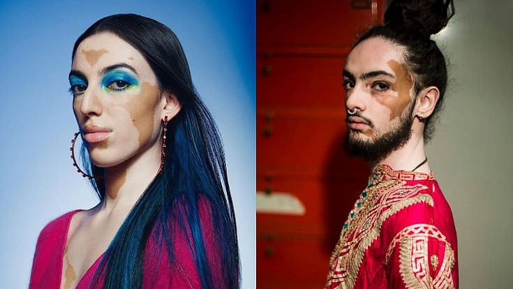 Indian Models With Vitiligo Are Championing Inclusivity And Self Love