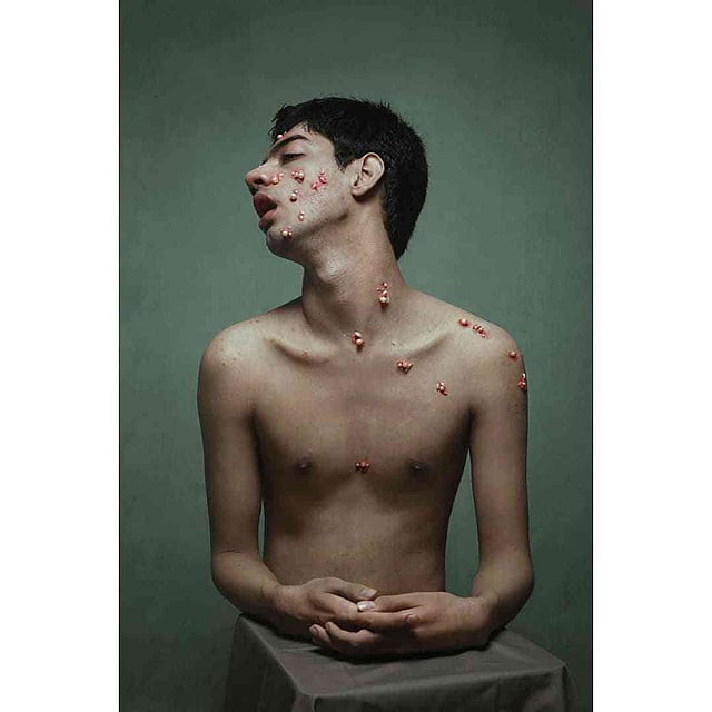 Surreal fine art Indian photography Teenage Scars on acne and beauty by ...