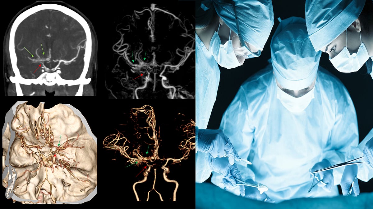 Apollo cancer center performs first brain bypass surgery on twins who ...