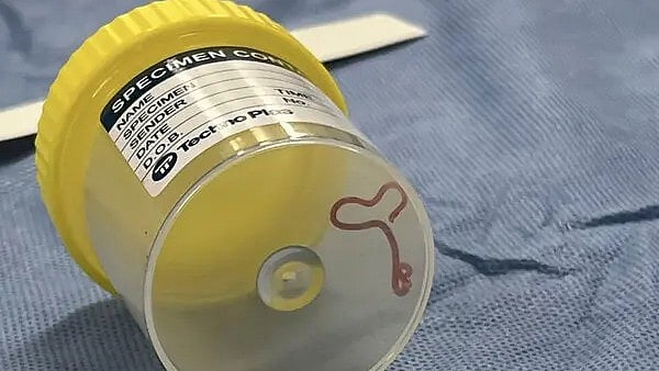 A live worm inside the woman's brain. Doctors warn.