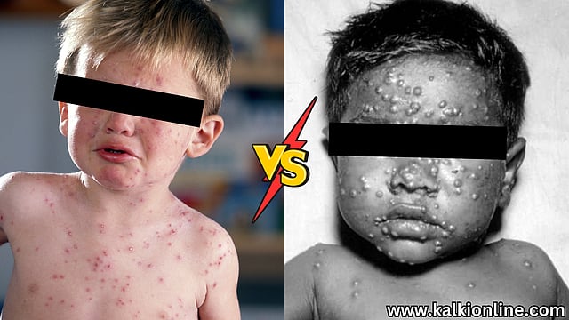Chickenpox Vs Smallpox: சின்னம்மை, பெரியம்மை என்ன வித்தியாசம் ...