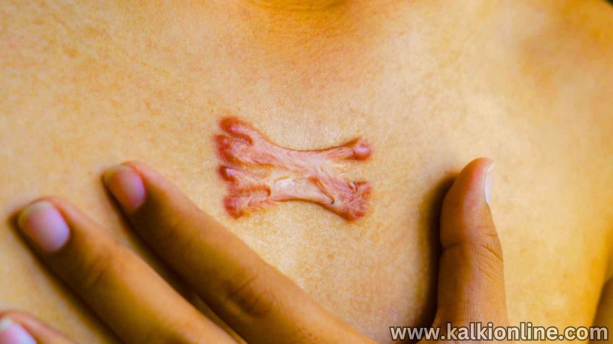 Keloid தழும்பு பற்றிய முழு விவரங்கள்!