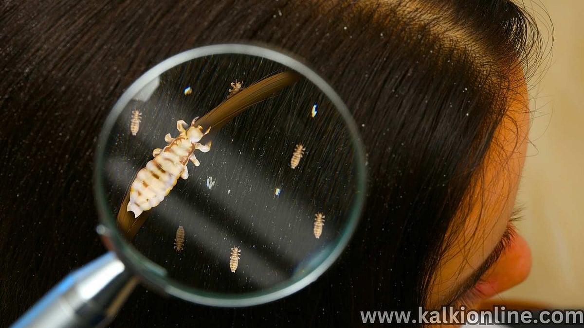 தலையில் பேன், ஈறு தொல்லை நீங்க சில எளிய டிப்ஸ்! Tips to get rid of head ...