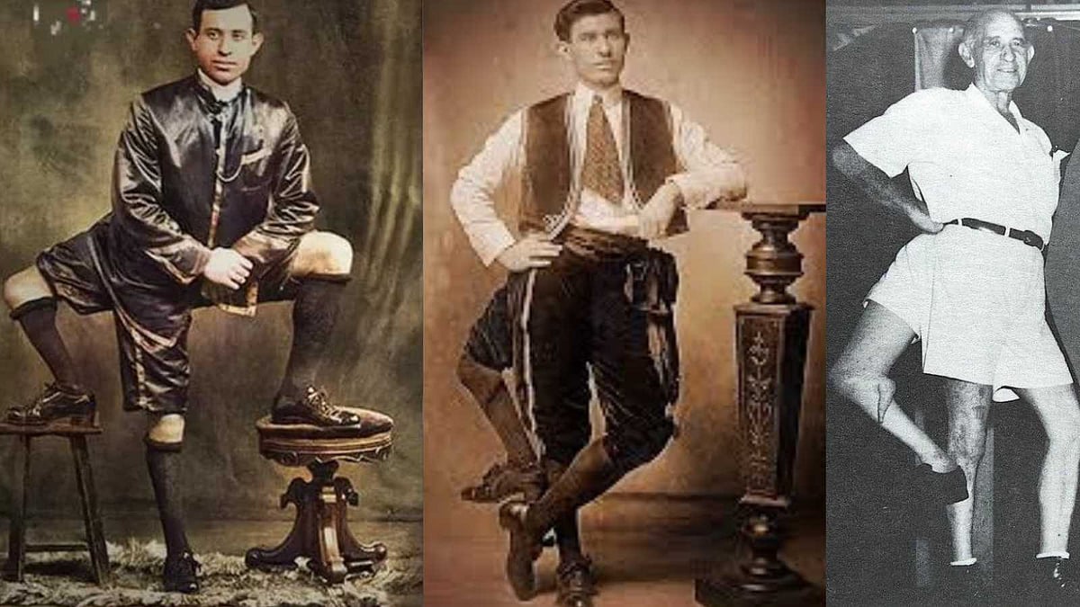 மூன்று கால்களை கொண்ட உலகின் விசித்திர மனிதர்! The strangest man in the ...