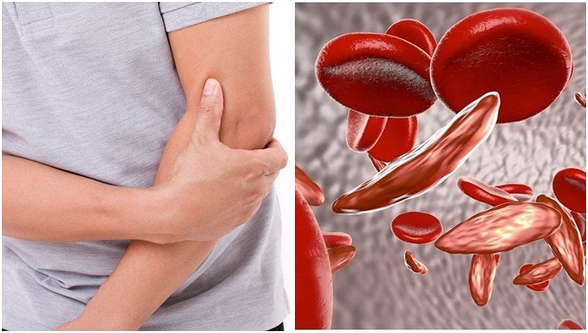 ಸಿಕಲ್ ಸೆಲ್ ಅನೀಮಿಯಾ ಅಥವಾ Sickle cell anemia (ಕುಶಲವೇ ಕ್ಷೇಮವೇ)