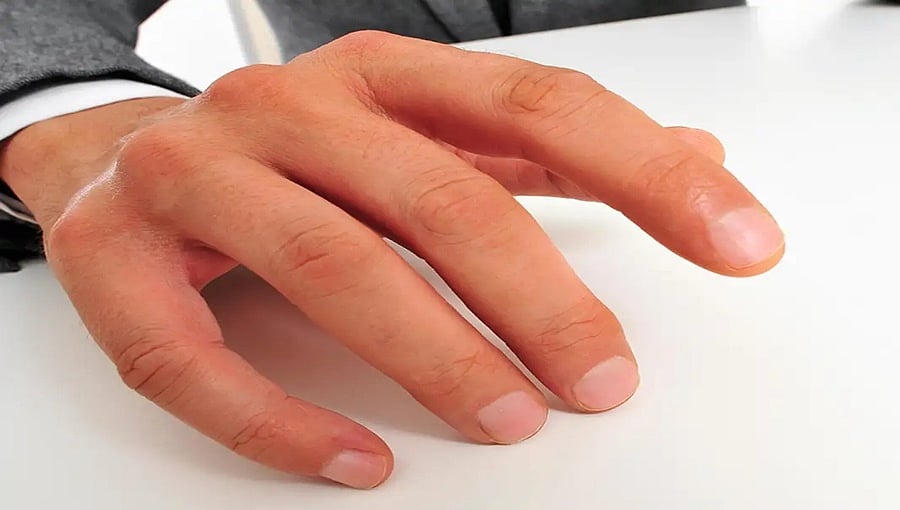 ಮುಳುವಾಯ್ತು ಮಹಿಳಾ ಸಹಪಾಠಿ ಜೊತೆ ಸಲುಗೆ: ಕೈ ಬೆರಳು ಕಳೆದುಕೊಂಡ ವಿದ್ಯಾರ್ಥಿ!