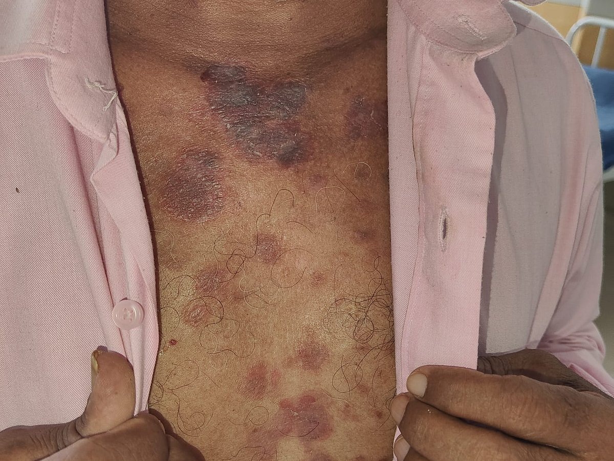 Is Pemphigus a Cancer? Doctor Clears the Myth