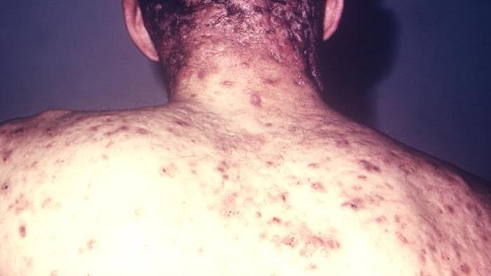 All about body acne and how to tackle it?