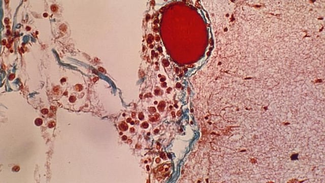 Risk of blood clots remains for almost a year after COVID-19 infection ...