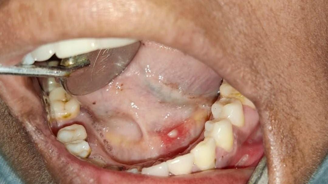 Traumatic Oral lesions: Symptoms and Prevention Methods.