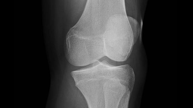Imaging Technique Reveals Fixation in Cementless Knee Replacement