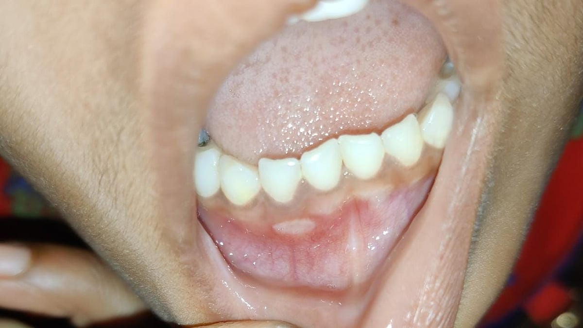 Traumatic Oral lesions: Symptoms and Prevention Methods.
