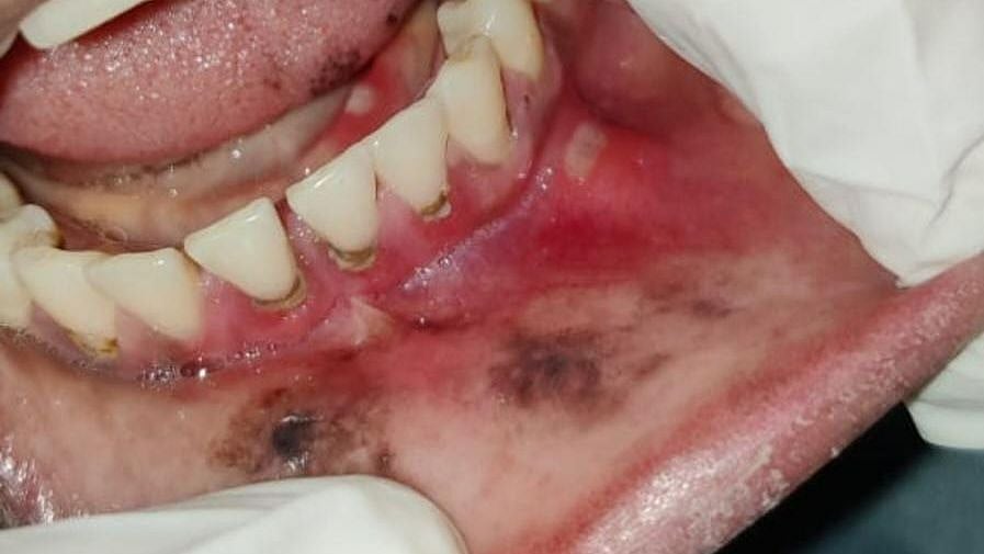 Traumatic Oral lesions: Symptoms and Prevention Methods.