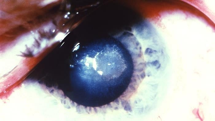Dry eye disease alters how the eye’s cornea heals itself after injury.