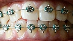 From wires to Invisalign