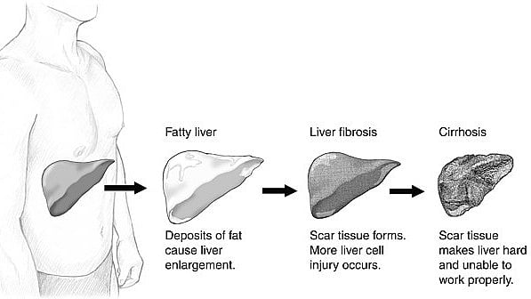 Consumption of fast food linked to liver disease