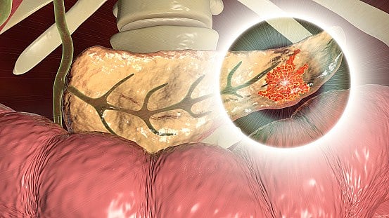 Can 'Inoperable' Pancreatic Tumors Be Safely Removed? New Study ...