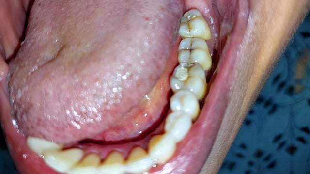 Wisdom tooth: A vestigial organ?