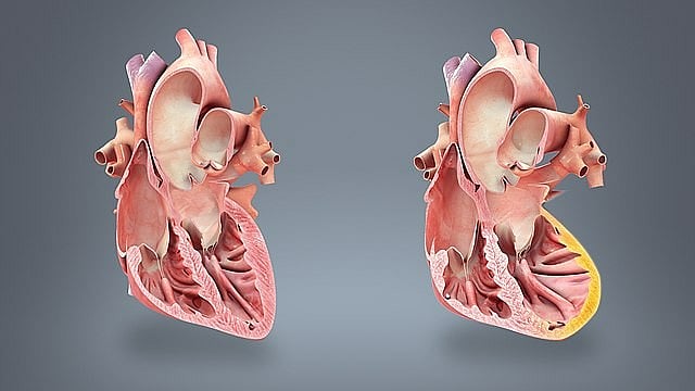 What is MINOCA? A Type of Heart Attack Mostly Affecting Women