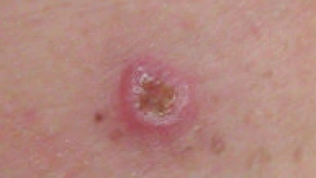 Use of Methotrexate is Associated with an Increased Risk of Skin Cancer