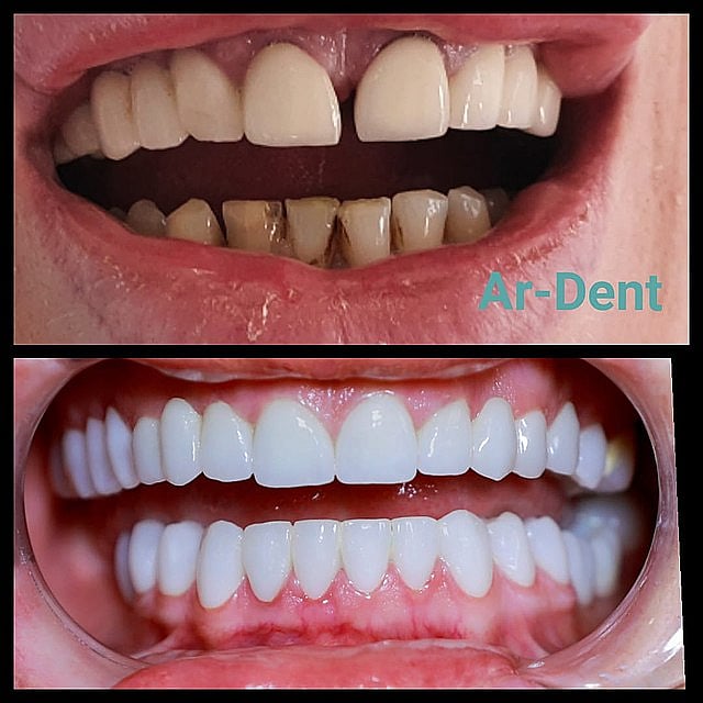 50 Shades of Teeth Discoloration: What Is Tooth Discoloration And ...