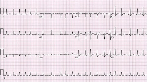 Ablation is safe and effective in treating atrial fibrillation ...