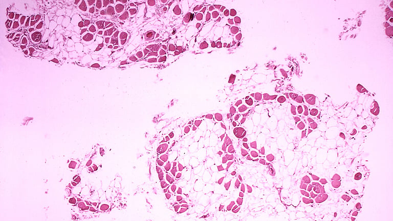 New Link Between Fatal Muscle Wasting Disease Gene and Cancer Discovered