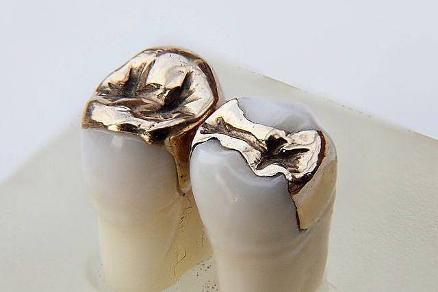 History and Evolution of Dental Filling Materials from Prehistoric to ...