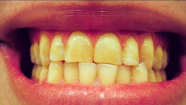 What Is Bruxism (Teeth Grinding)? Grinding To The Crux Of The Matter