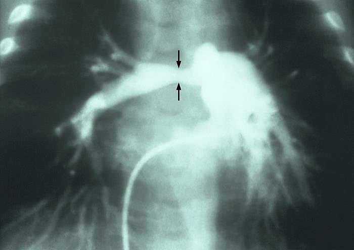 The Accidental Discovery of the First Coronary Angiogram